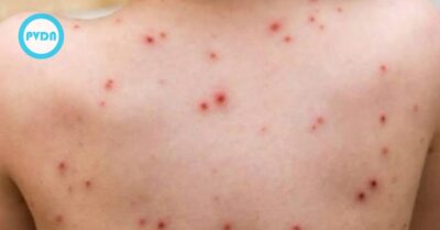 Measles reaches all 32 Mexican states as Puebla confirms first case ...